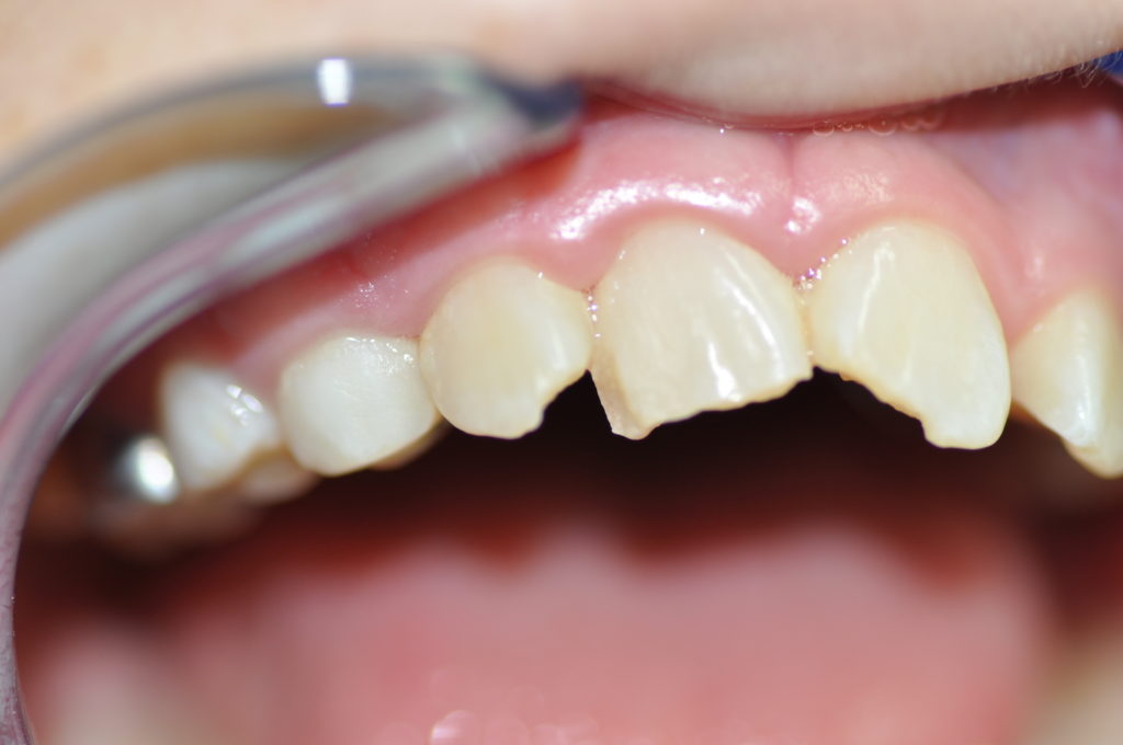 Denti caduti o rotti a causa di un trauma: un danno irreparabile ...